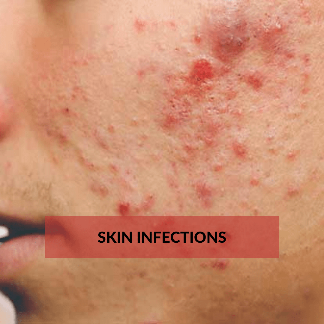 Skin Infections, Types, Causes, Relationships, and Remedies