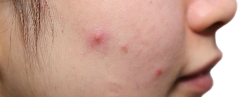 How to reduce swelling on the face from infected pimples?