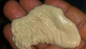 Pictures of Yeast Infection in Vagina: Images and Photos